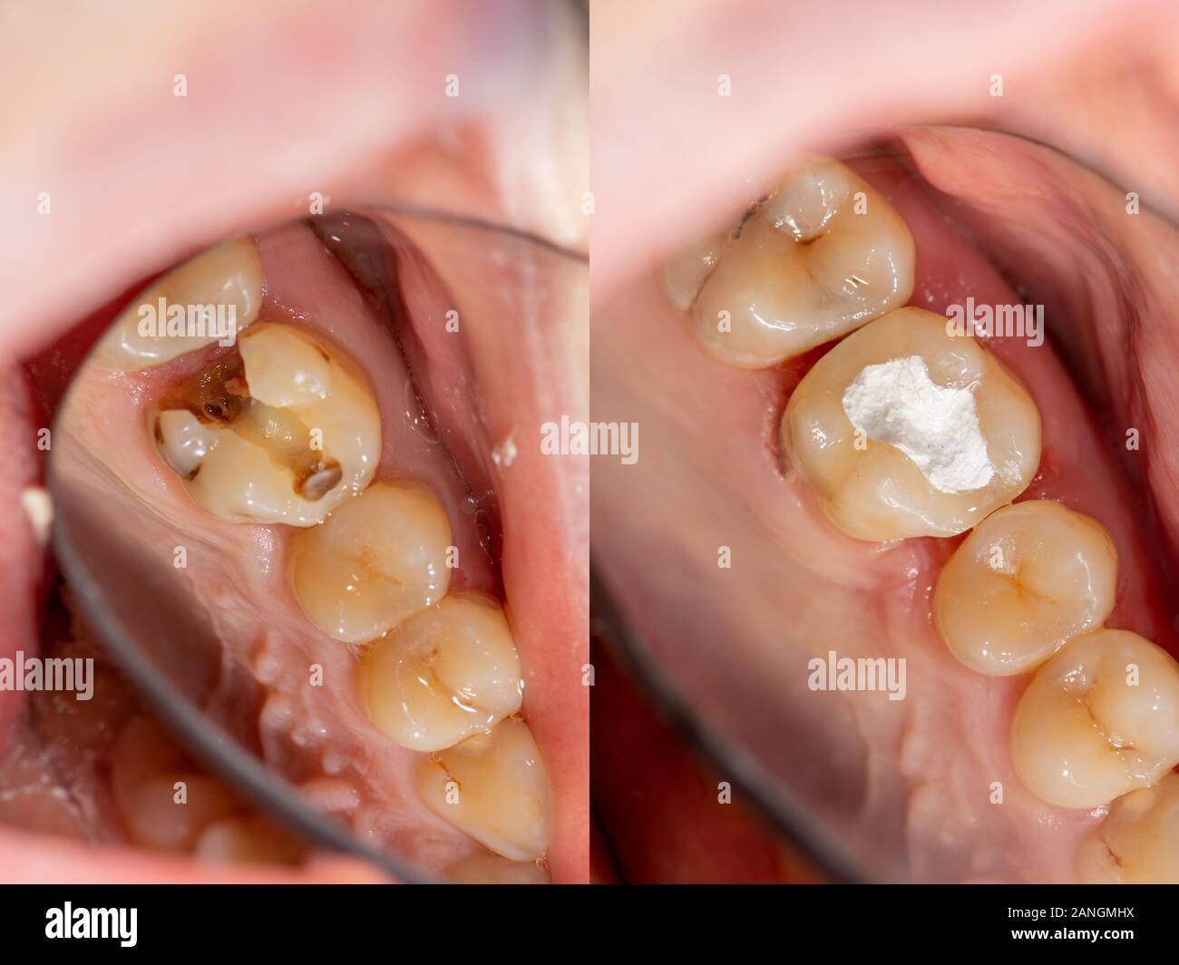 Roots Of Teeth Stock Photos & Roots Of Teeth Stock Images - Alamy