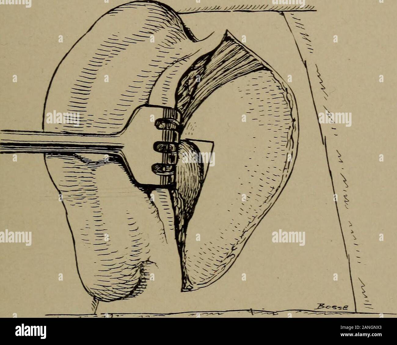 A manual of otology for students and practitioners . Fig. G8.—Incision ...