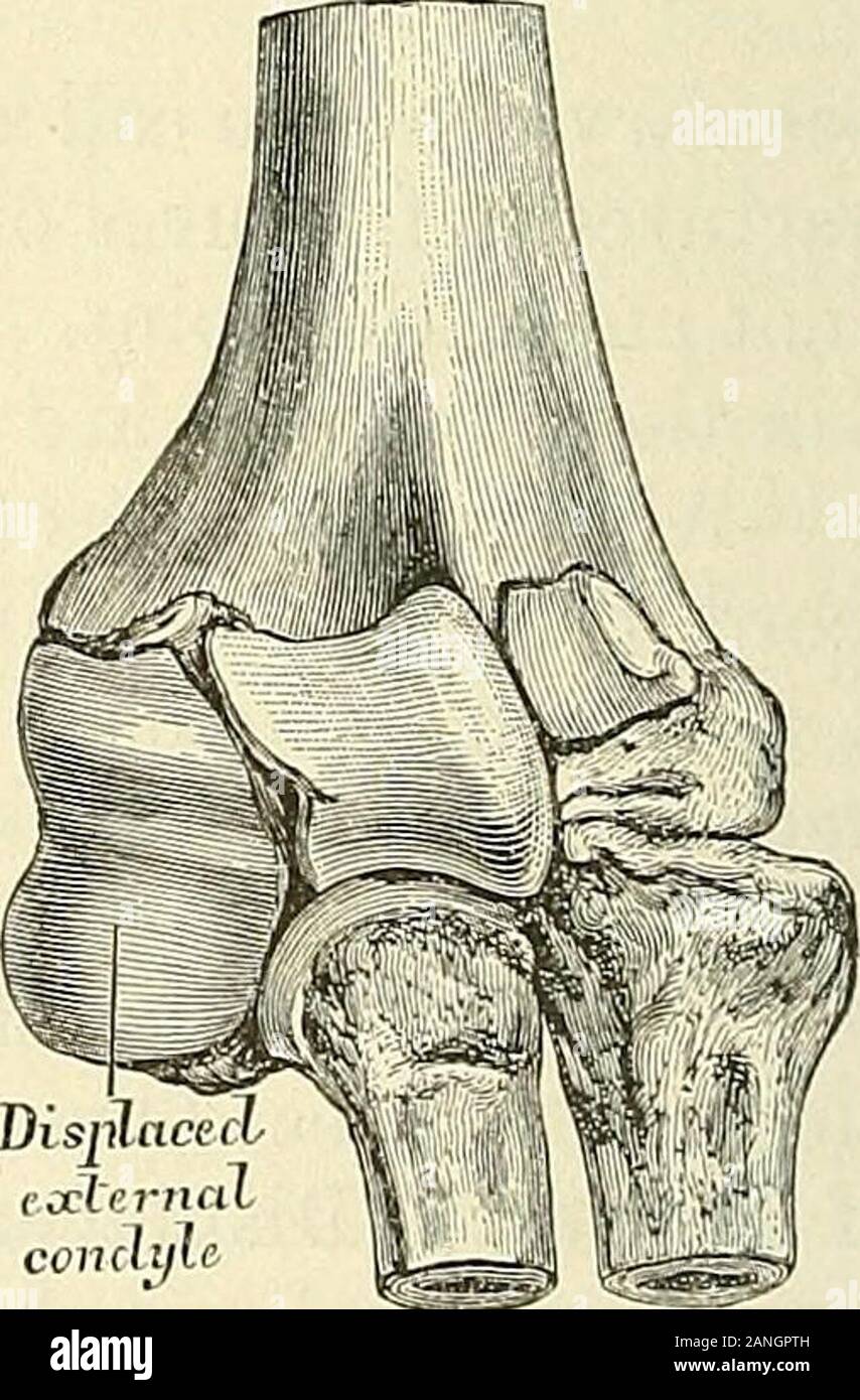 Displaced fracture hi-res stock photography and images - Alamy