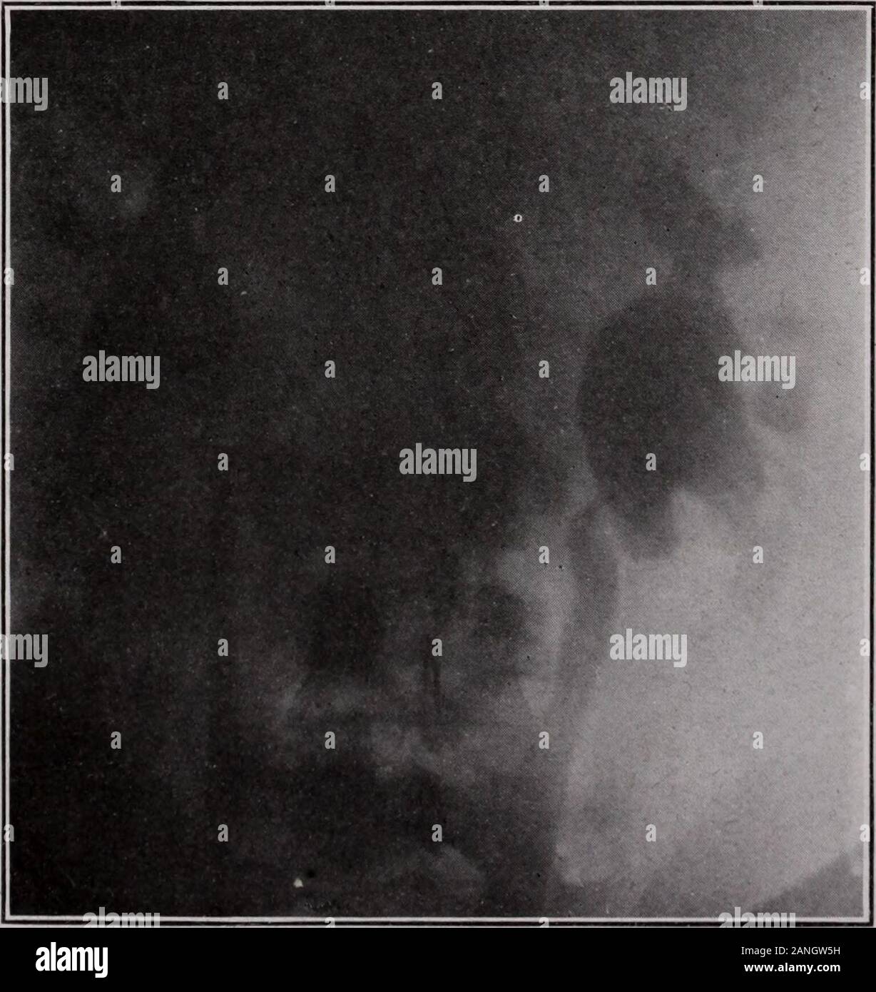 Pyelitis hi-res stock photography and images - Alamy