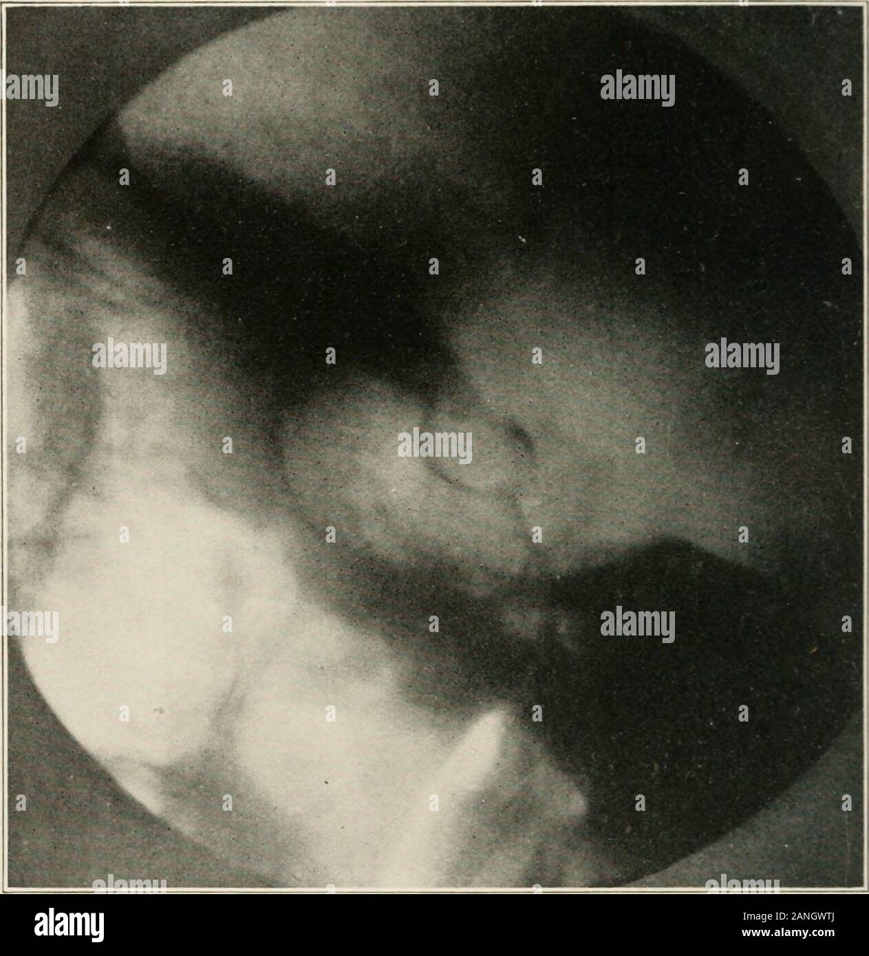 Exophthalmos hi-res stock photography and images - Alamy