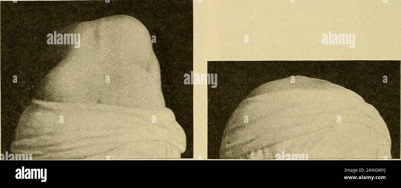 Lateral curvature of the spine and round shoulders . clinical ...