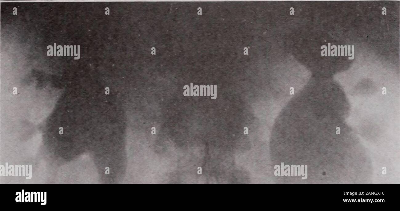 Pyelitis hi-res stock photography and images - Alamy