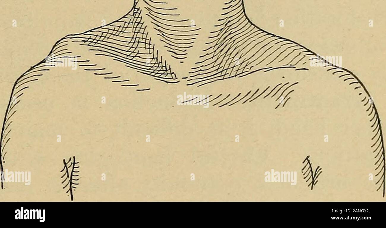 Clavicle fractures hi-res stock photography and images - Alamy