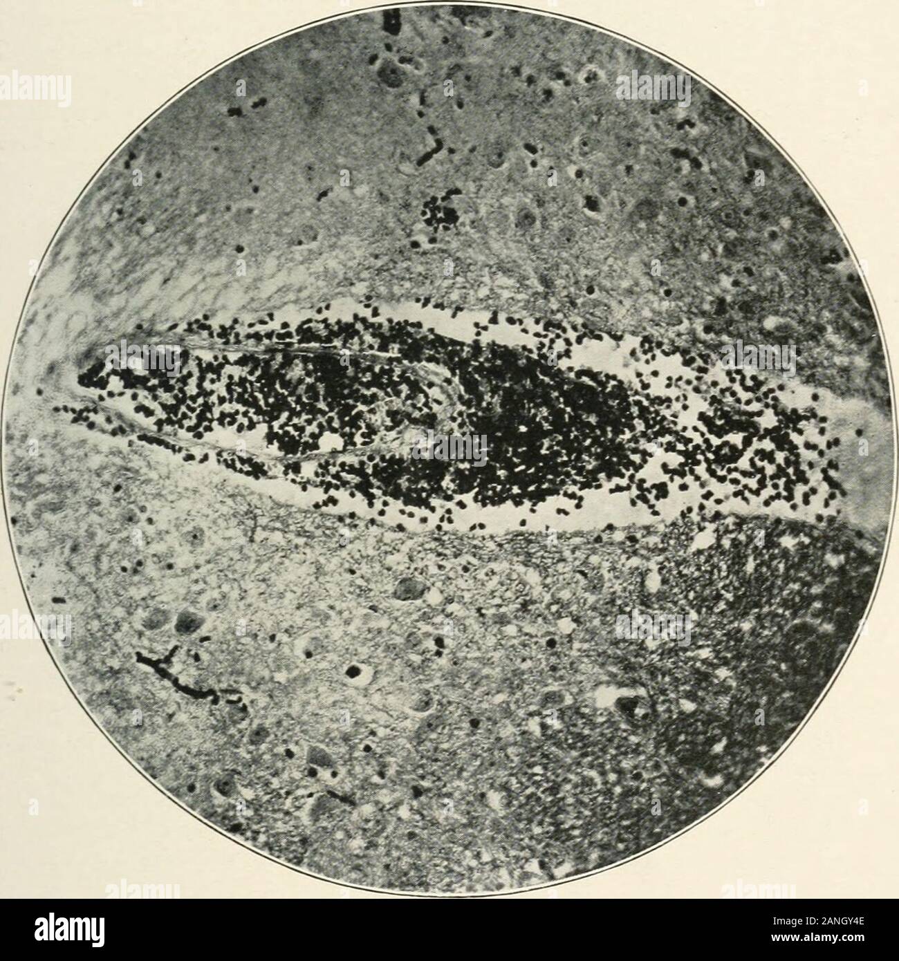 Poly Mononuclear Cells