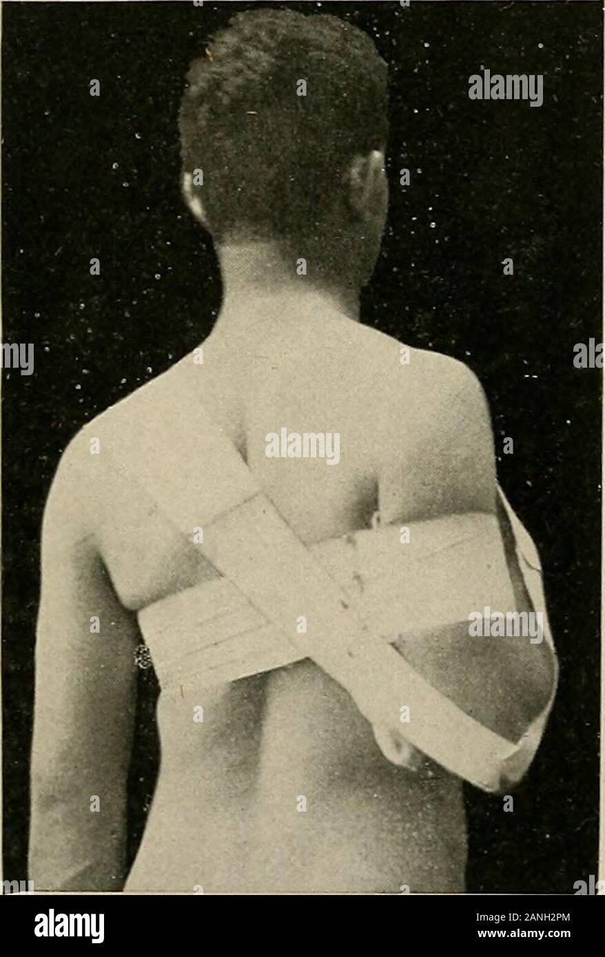 The practice of surgery . Fig. 545.—Fracture of the left clav-icle ...