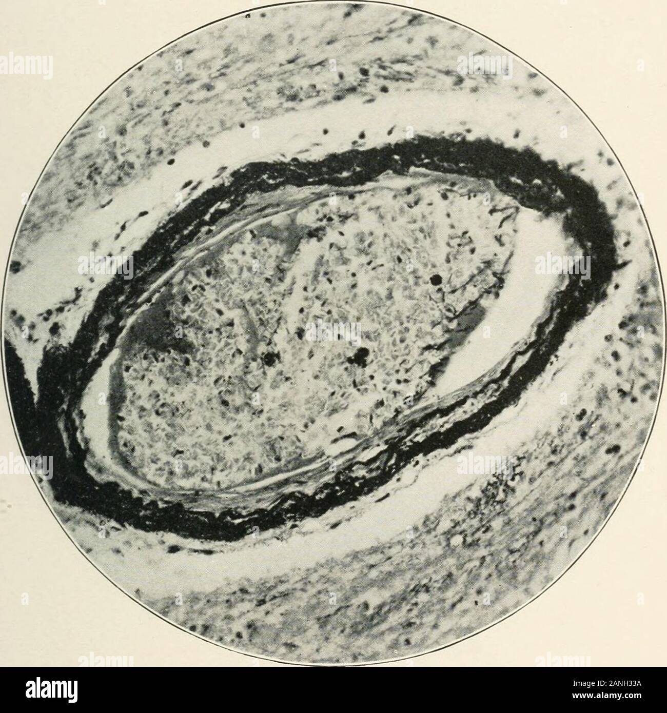 AMAarchives of neurology & psychiatry . Babinski sign and no clonus ...