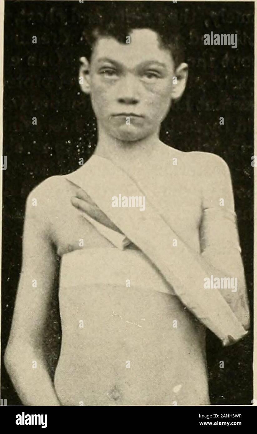 The practice of surgery . Fig. 545.—Fracture of the left clav-icle ...