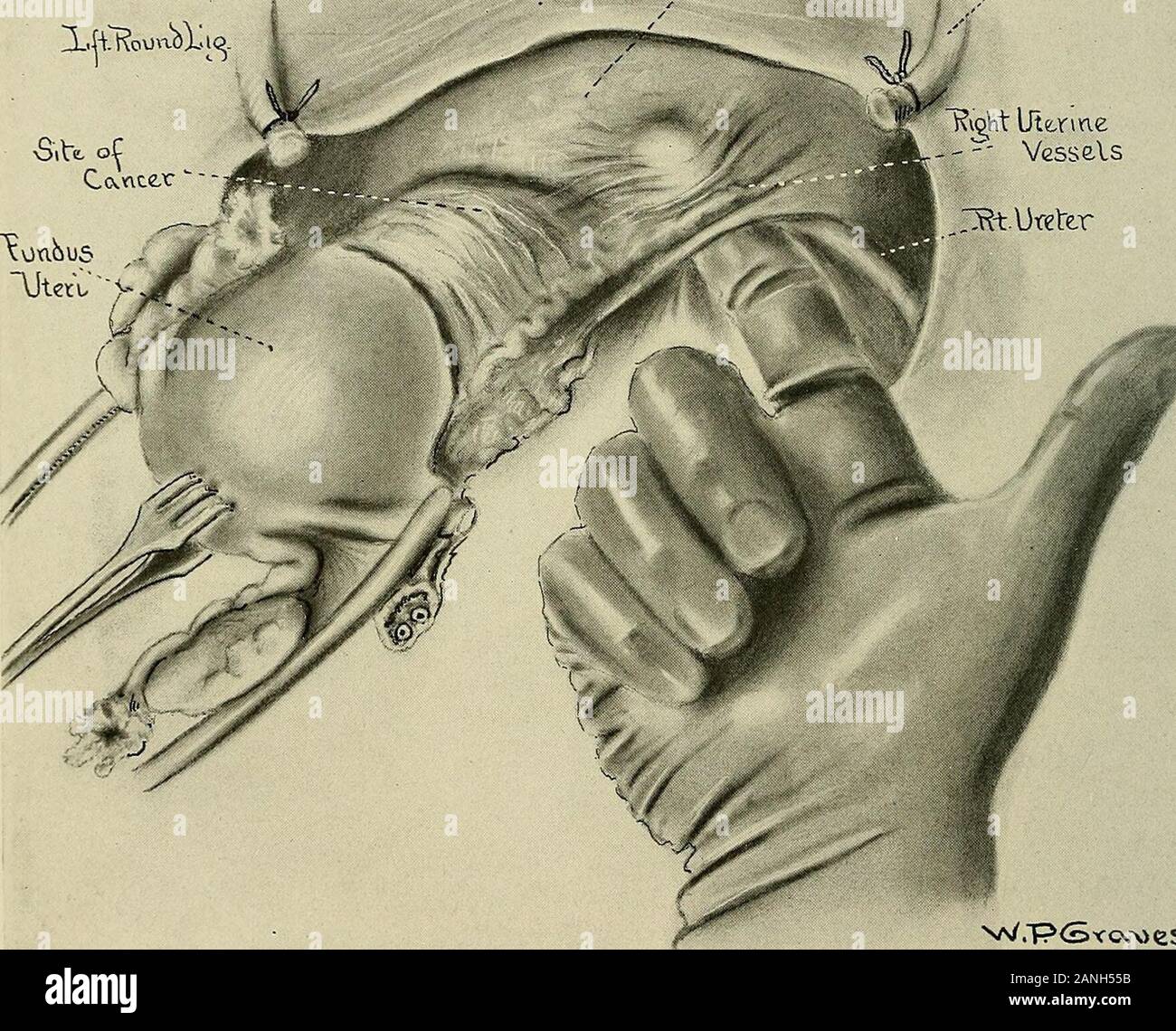 Gynecology . depicted in Fig. 348.When the finger has been properly ...