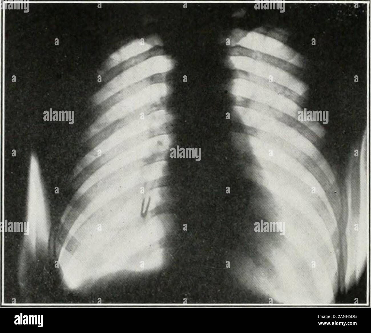 Laryngeal edema hi-res stock photography and images - Alamy