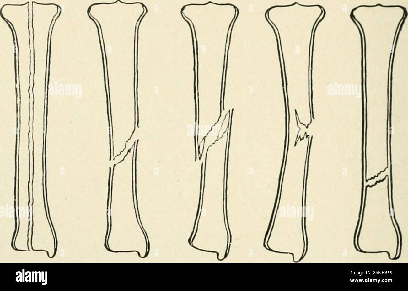 The practice of surgery . Fig. 538.—Various forms of lines of fracture ...