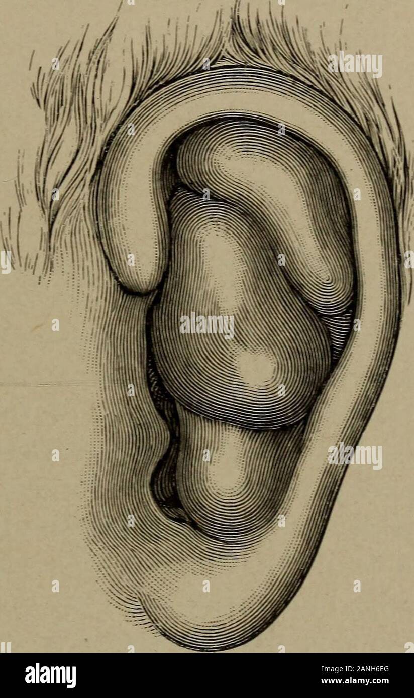 Othematoma hi-res stock photography and images - Alamy