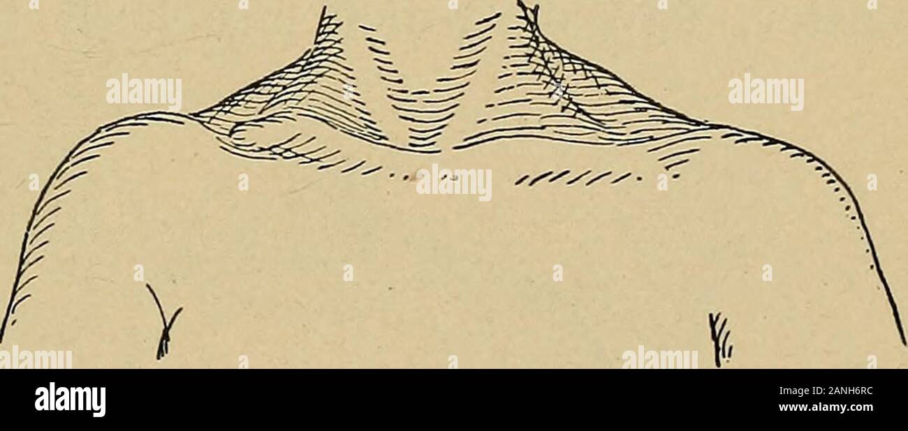Atlas and epitome of traumatic fractures and dislocations . Fig. 36 ...
