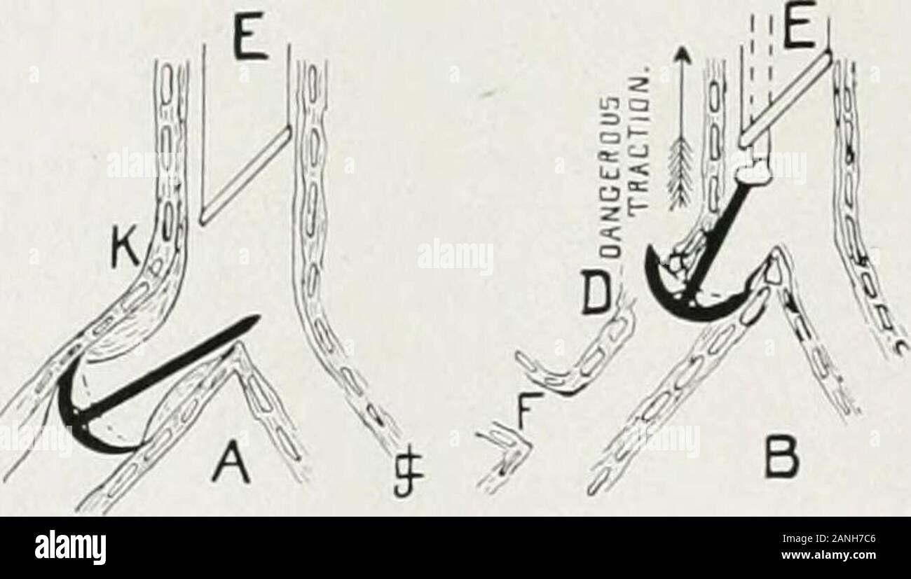 Push endoscopy hi-res stock photography and images - Alamy