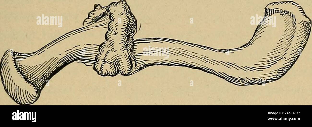 Atlas and epitome of traumatic fractures and dislocations . FRACTURES ...