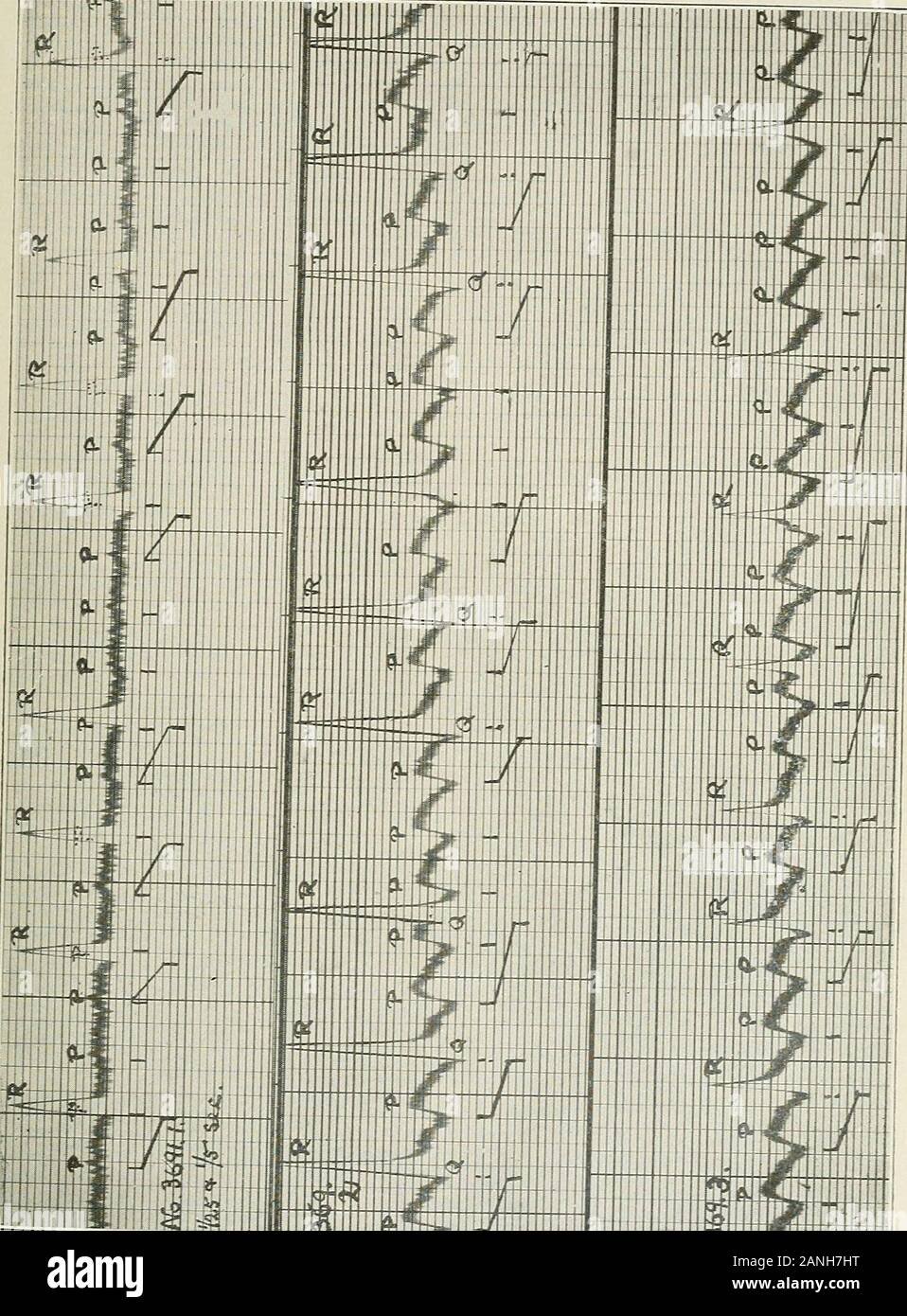 Right bundle branch block hi-res stock photography and images - Alamy