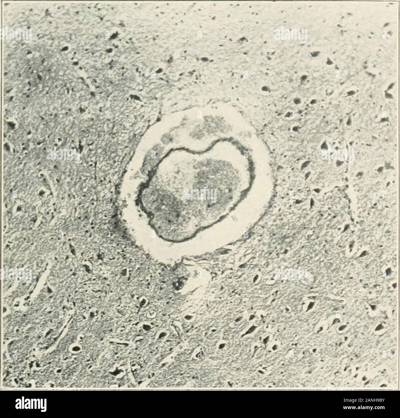 Polymorphonuclear Cell High Resolution Stock Photography and Images - Alamy