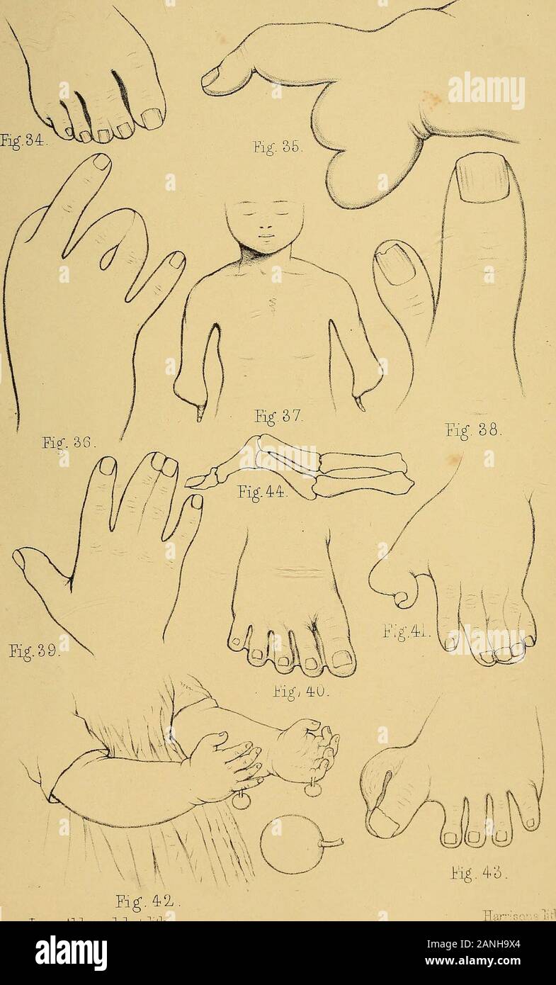 The malformations, diseases and injuries of the fingers and toes and ...