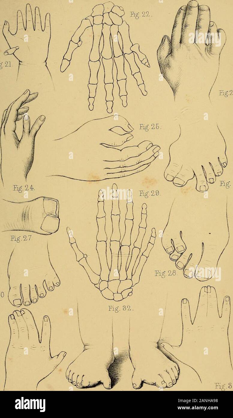 The malformations, diseases and injuries of the fingers and toes and ...