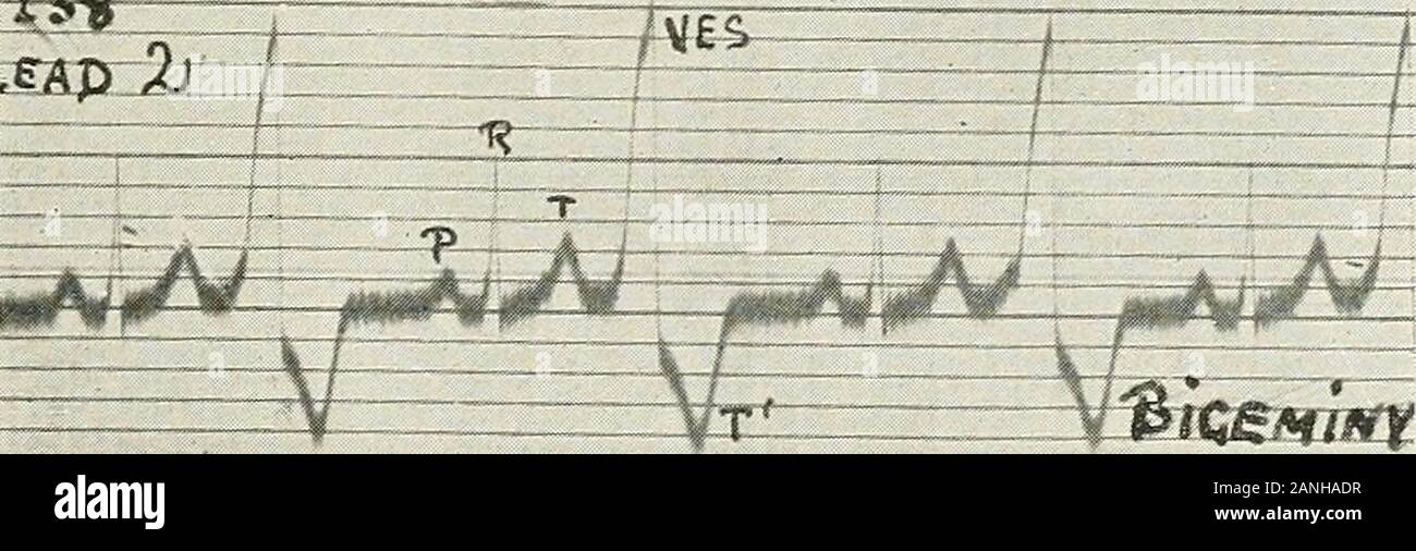 Extrasystole High Resolution Stock Photography and Images - Alamy