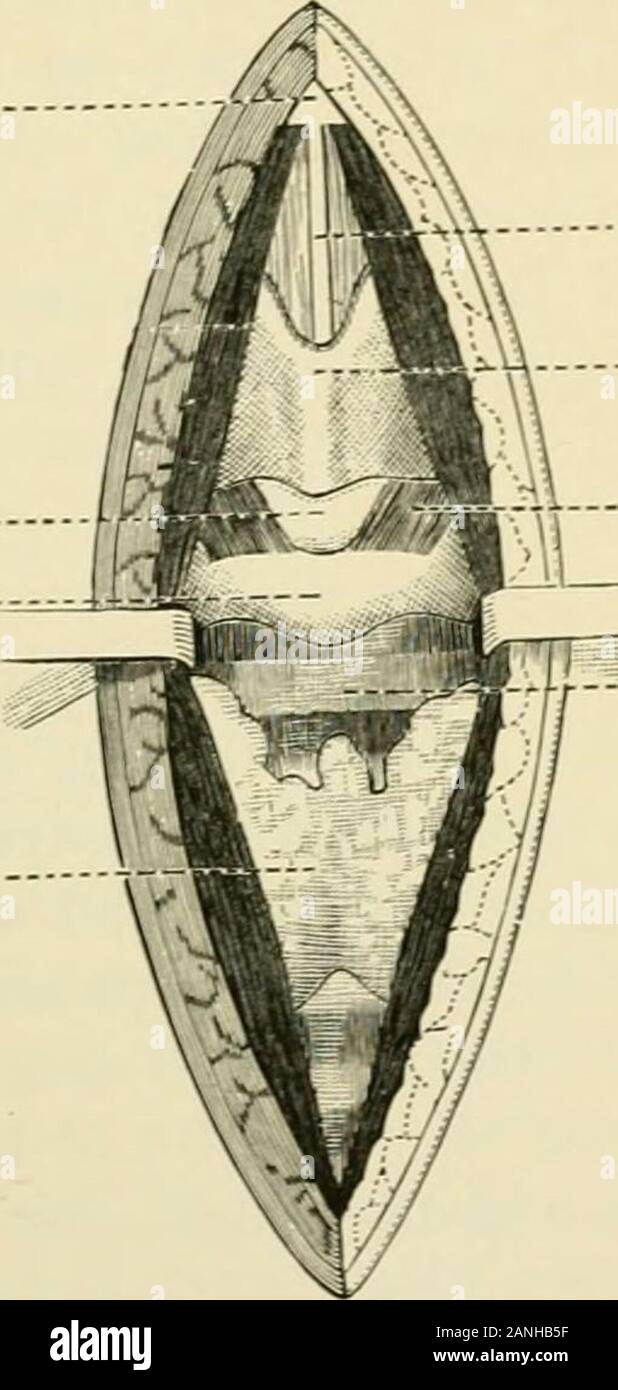 Operative surgery . n-g. Isthmus of thyroid body, with ghip, and which ...