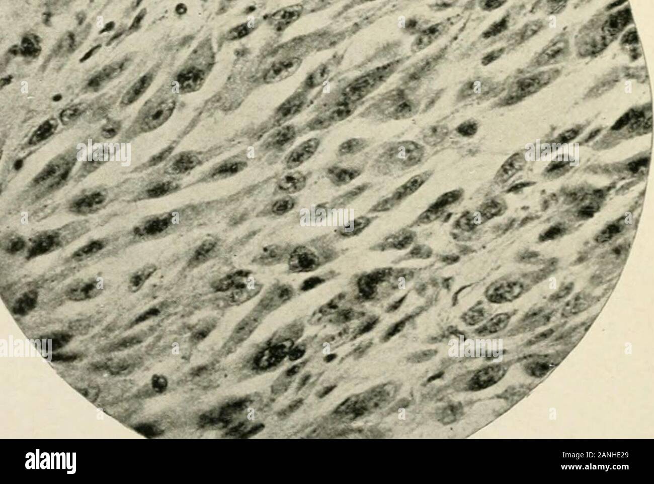 Spindle cell sarcoma hi-res stock photography and images - Alamy