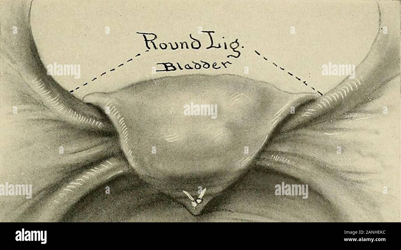 Gynecology . 3)o W.-P.G,. Fig. 327.—Supravaginal Hysterectomy. The ...