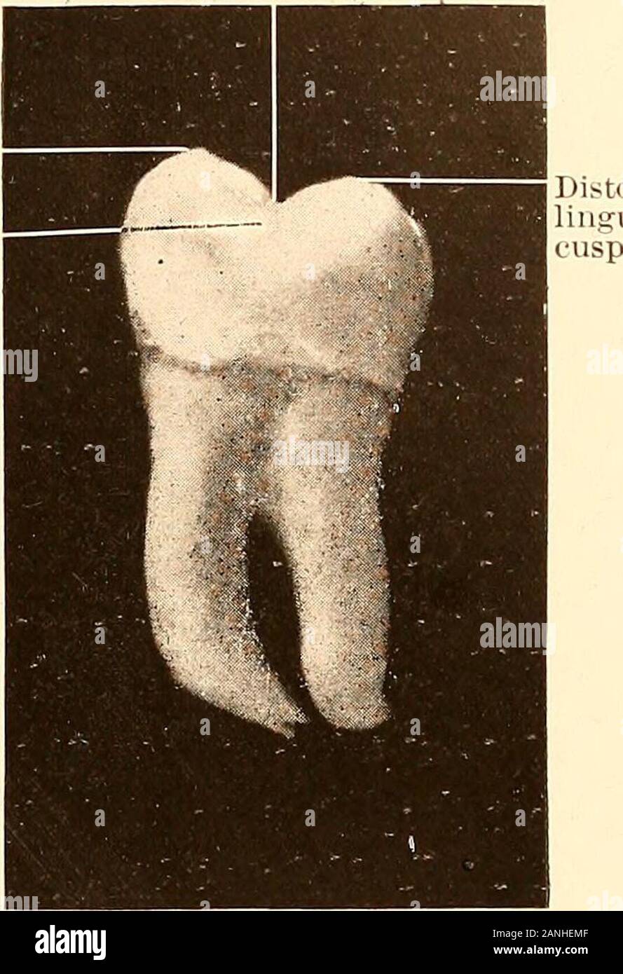 Molar inferior hi-res stock photography and images - Alamy