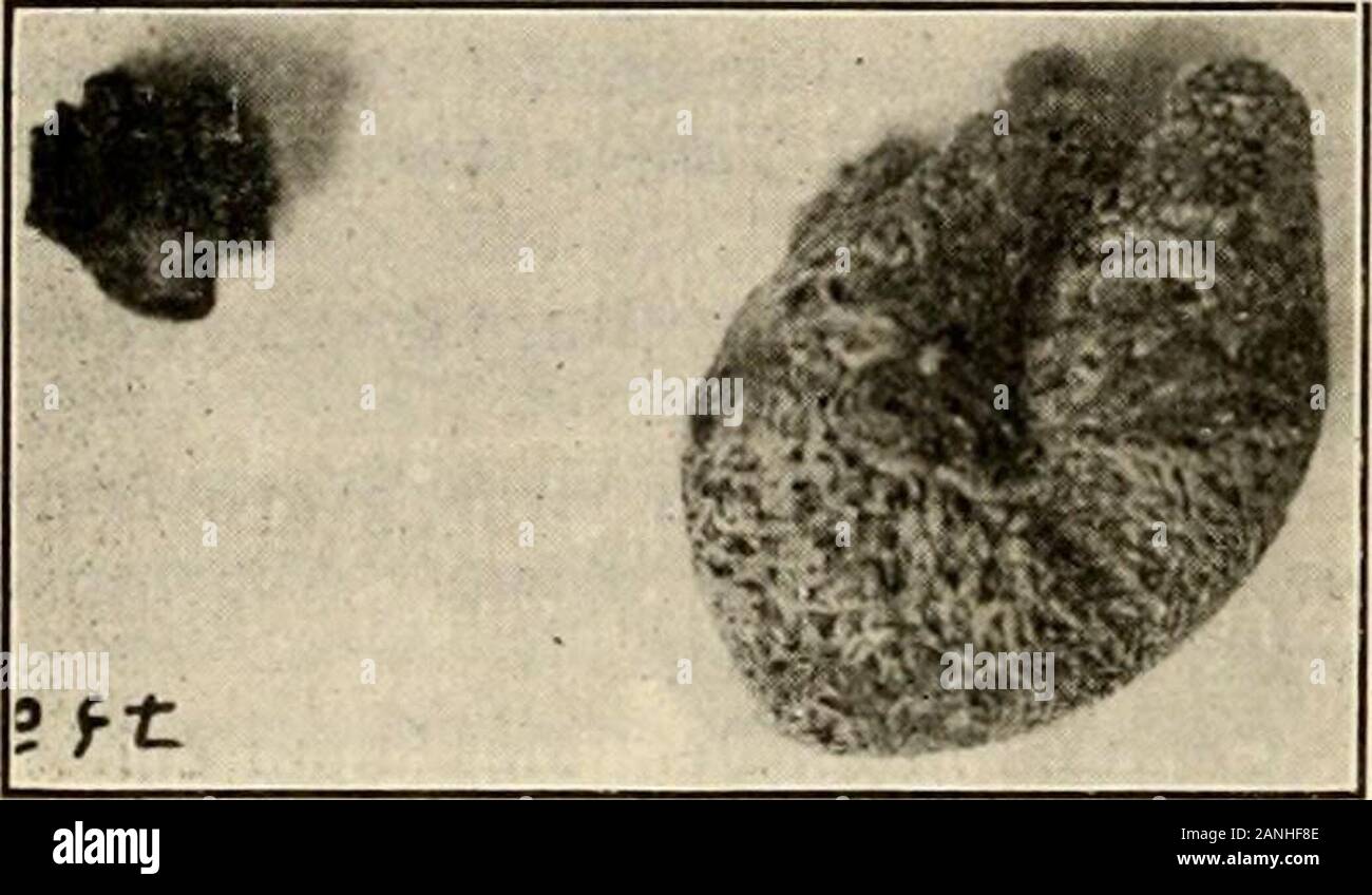 Urethral catheter hi-res stock photography and images - Alamy