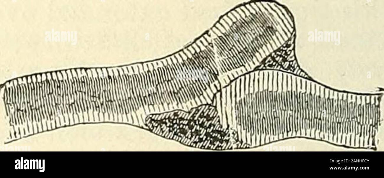 A practical treatise on fractures and dislocations . Repair of fracture ...