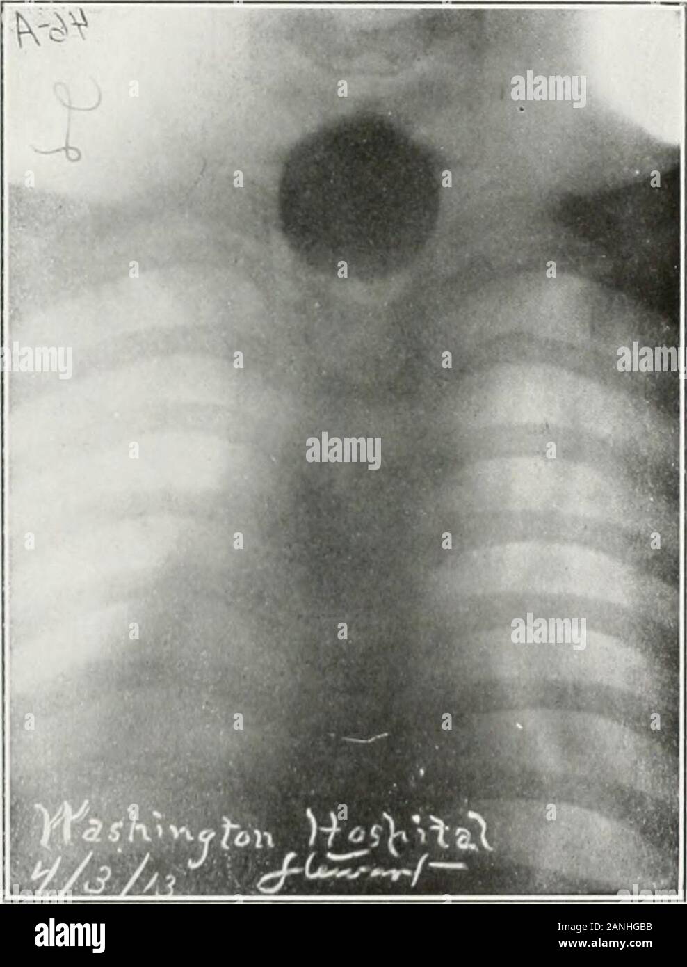 Obstructed bronchus hi-res stock photography and images - Alamy