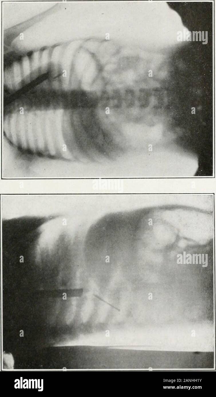Withdrawal method hi-res stock photography and images - Alamy