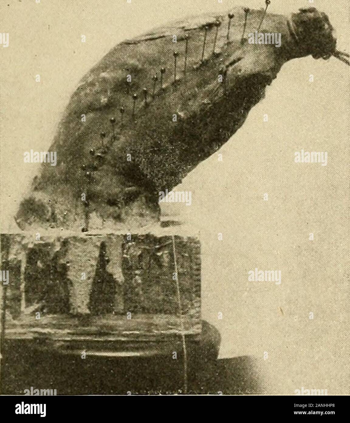 Lateral curvature of the spine and round shoulders . ardthe convexity ...