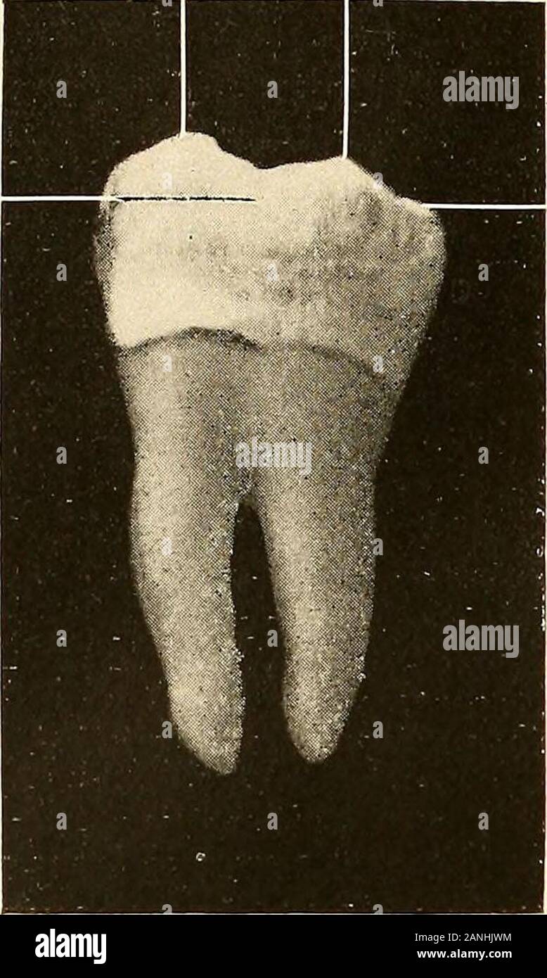 Third molar hi-res stock photography and images - Alamy