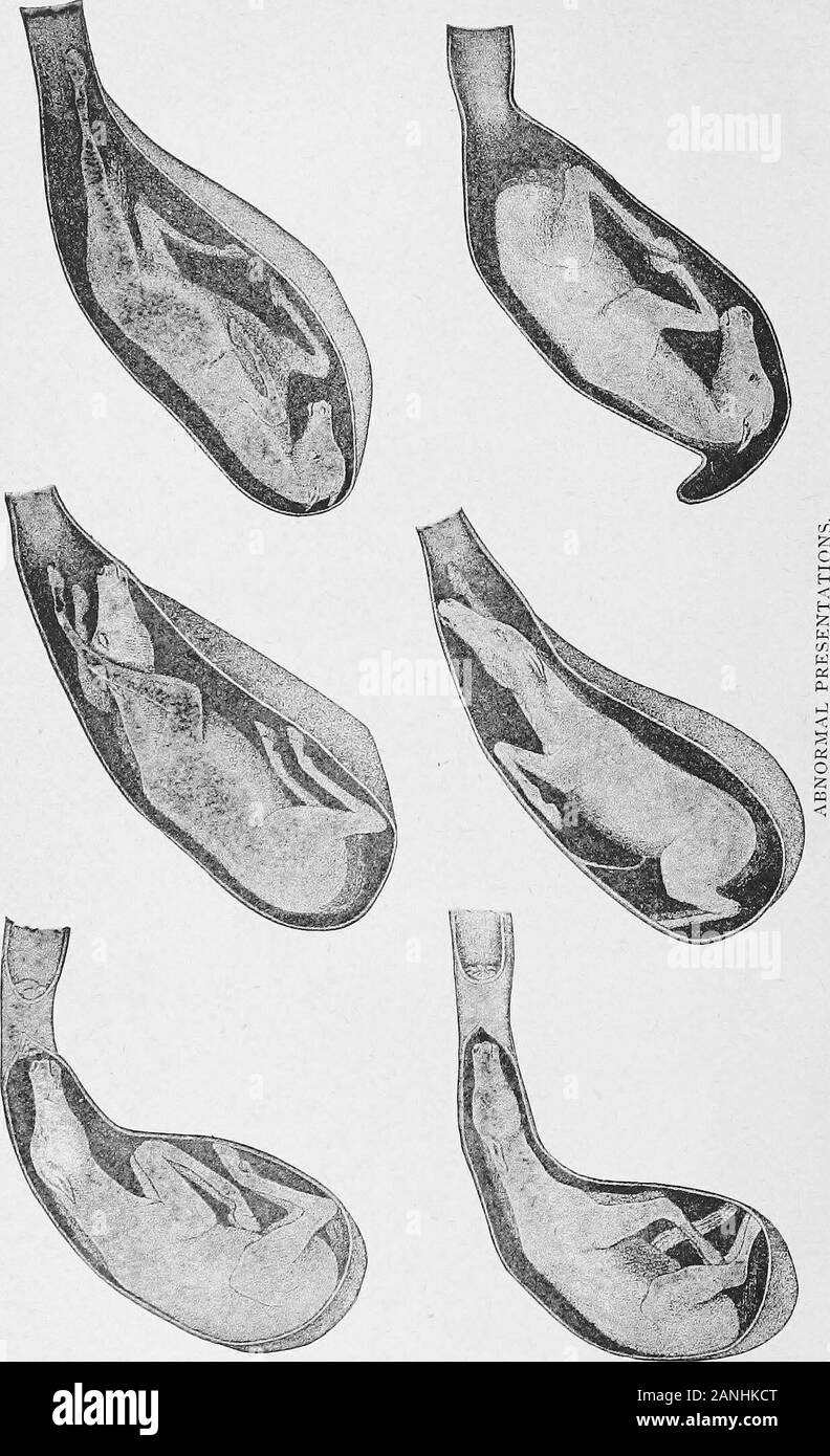 Malpresentation hi-res stock photography and images - Alamy