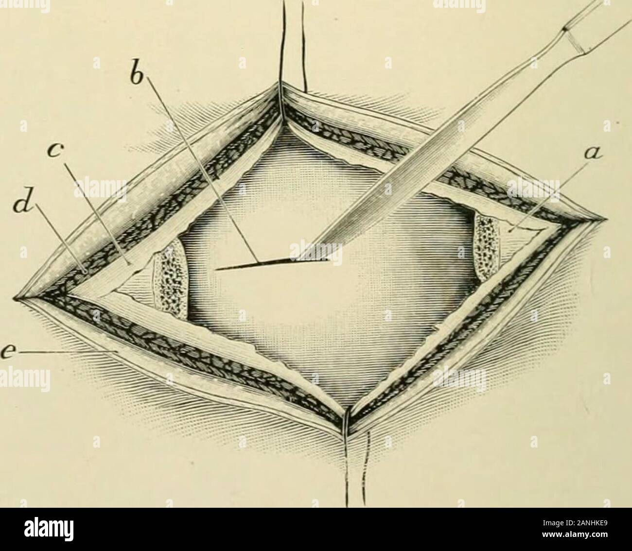 Operative surgery . ge tube should beincompressible, should just reach ...
