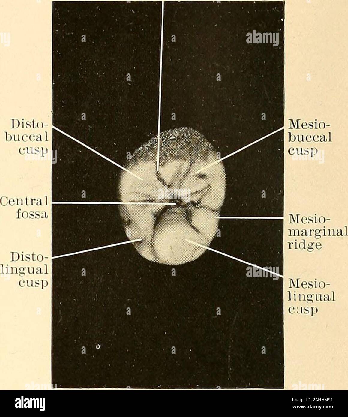 Principles and practice of operative dentistry . Disto-lingual ...