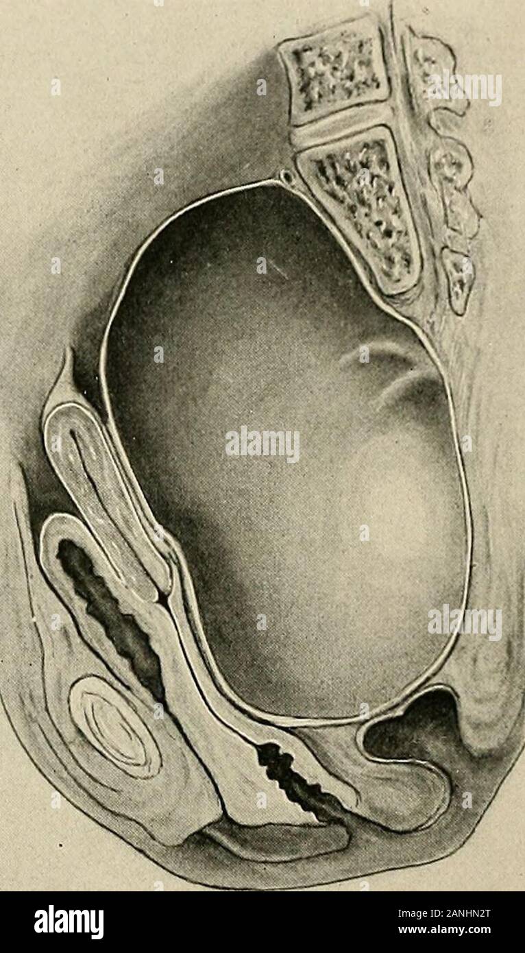 The practice of surgery . Fig. 510.—Cyst of the mesentery(Vander Veer ...