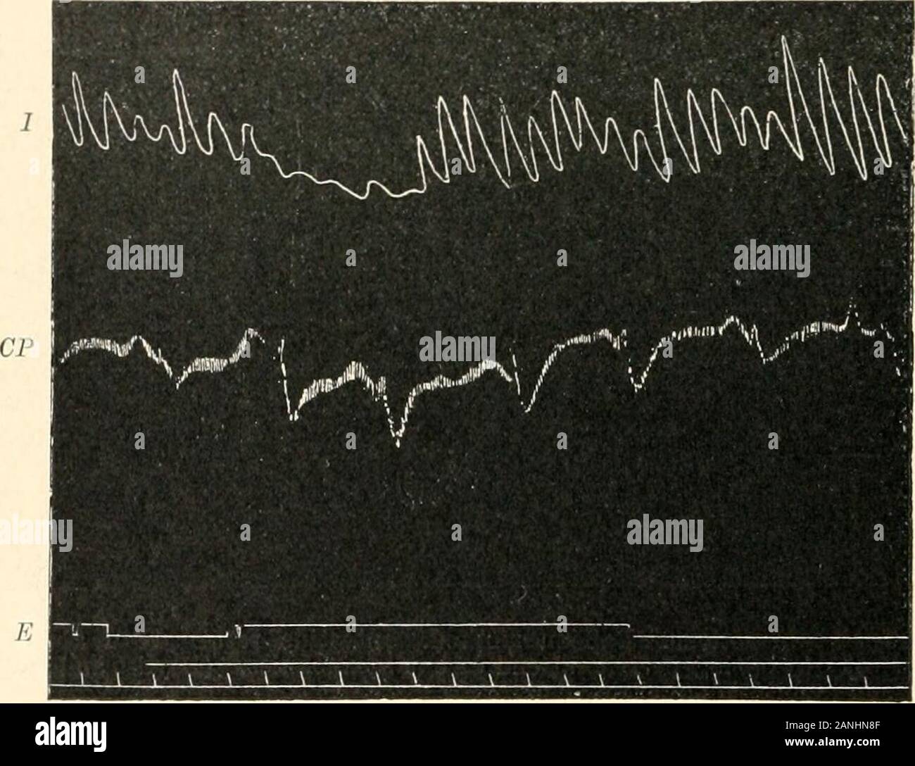 Hyperaemic hi-res stock photography and images - Alamy