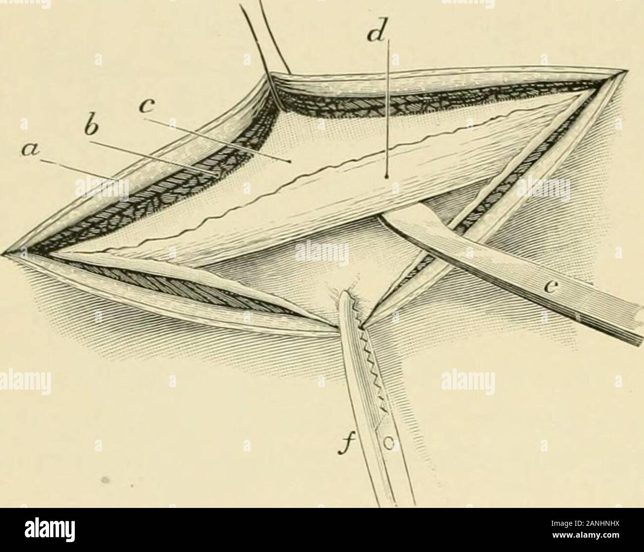 Thoracotomy hi-res stock photography and images - Alamy