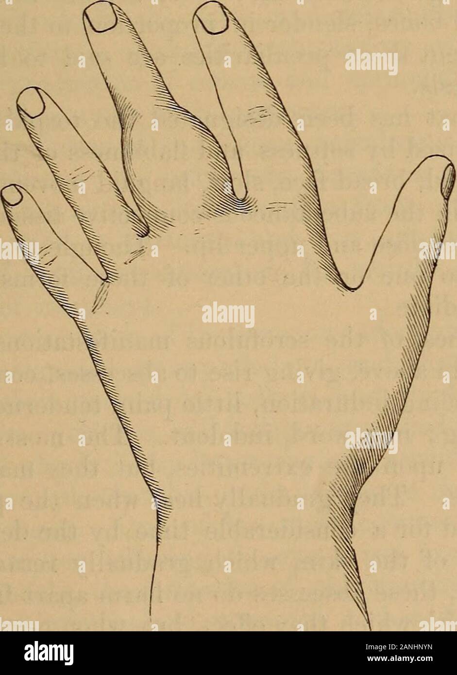 A treatise on the diseases of infancy and childhood . ght injuries, and ...