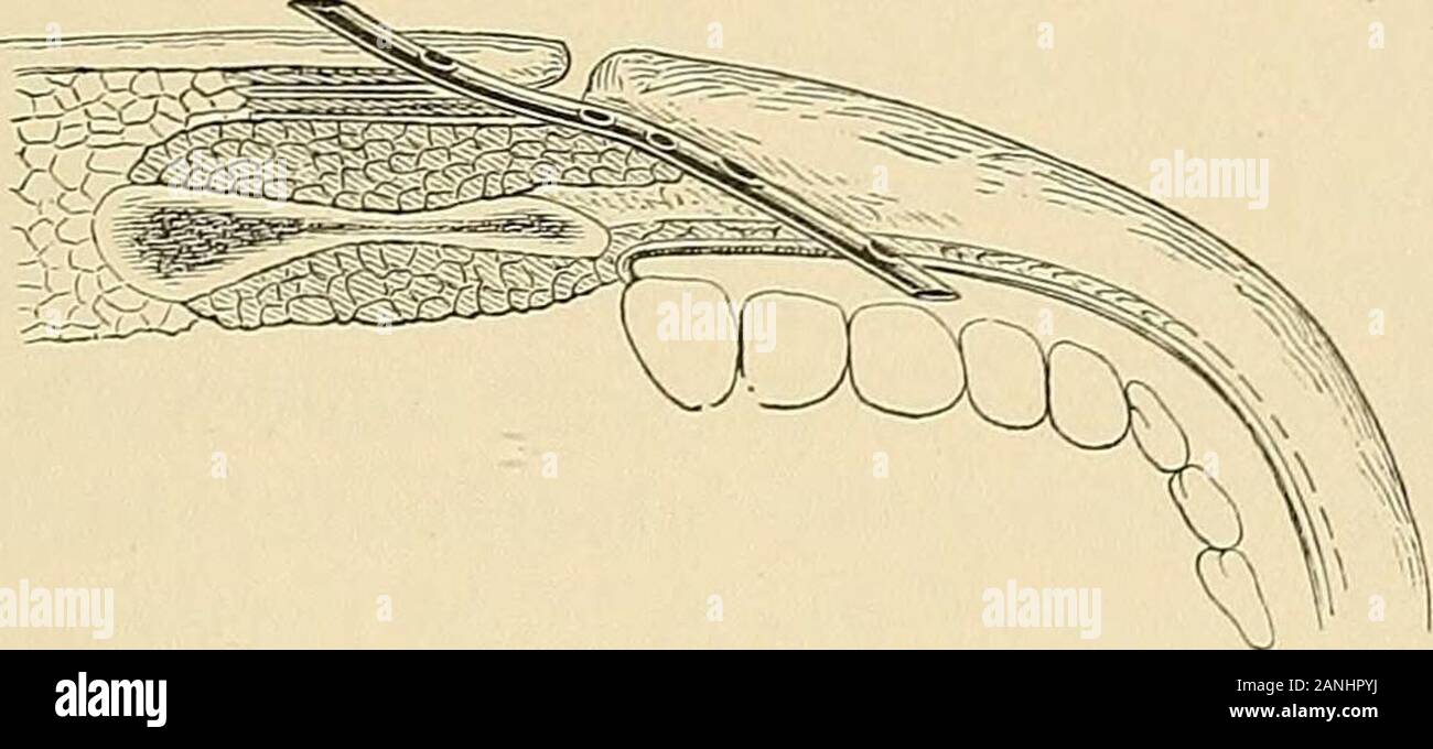 Fistula needle hi-res stock photography and images - Alamy