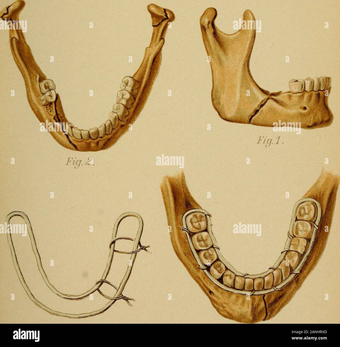Retention sutures hi-res stock photography and images - Alamy