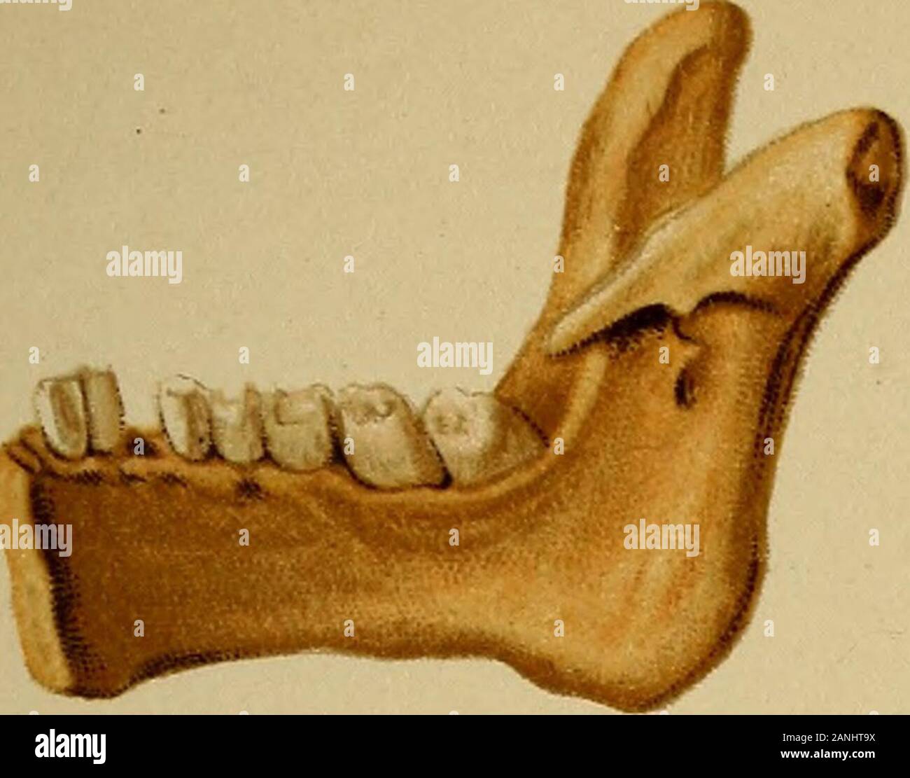 Alveolar fracture hi-res stock photography and images - Alamy