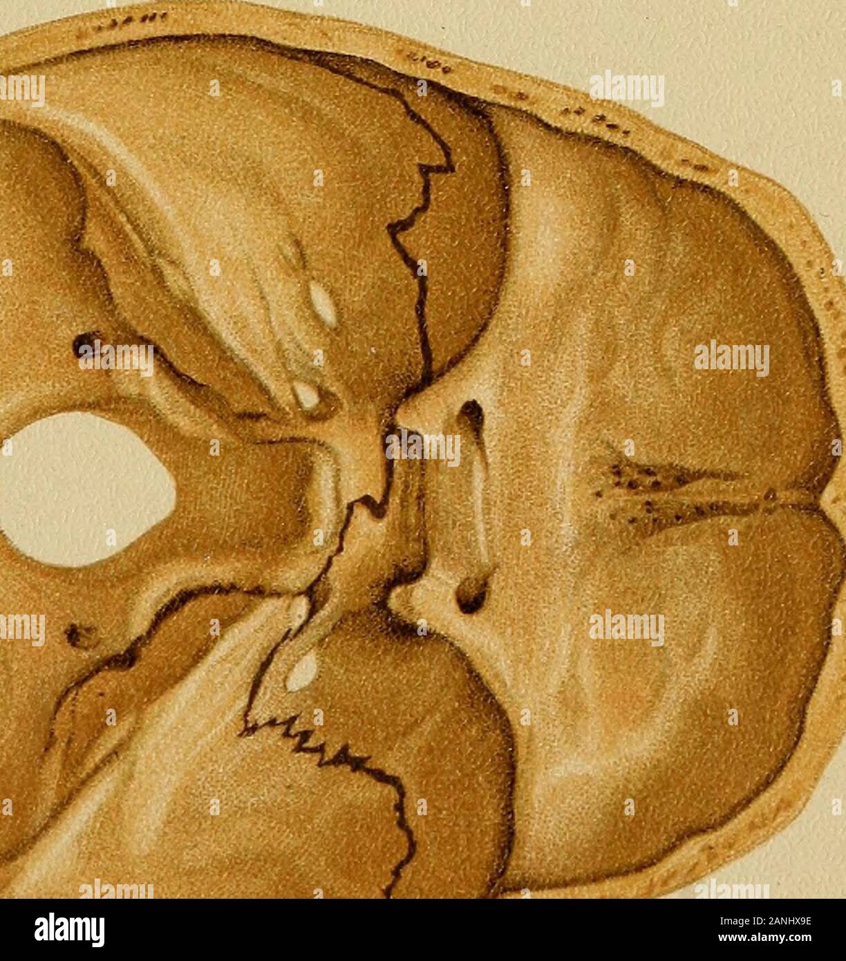 Atlas and epitome of traumatic fractures and dislocations . FlgJi. r. j ...