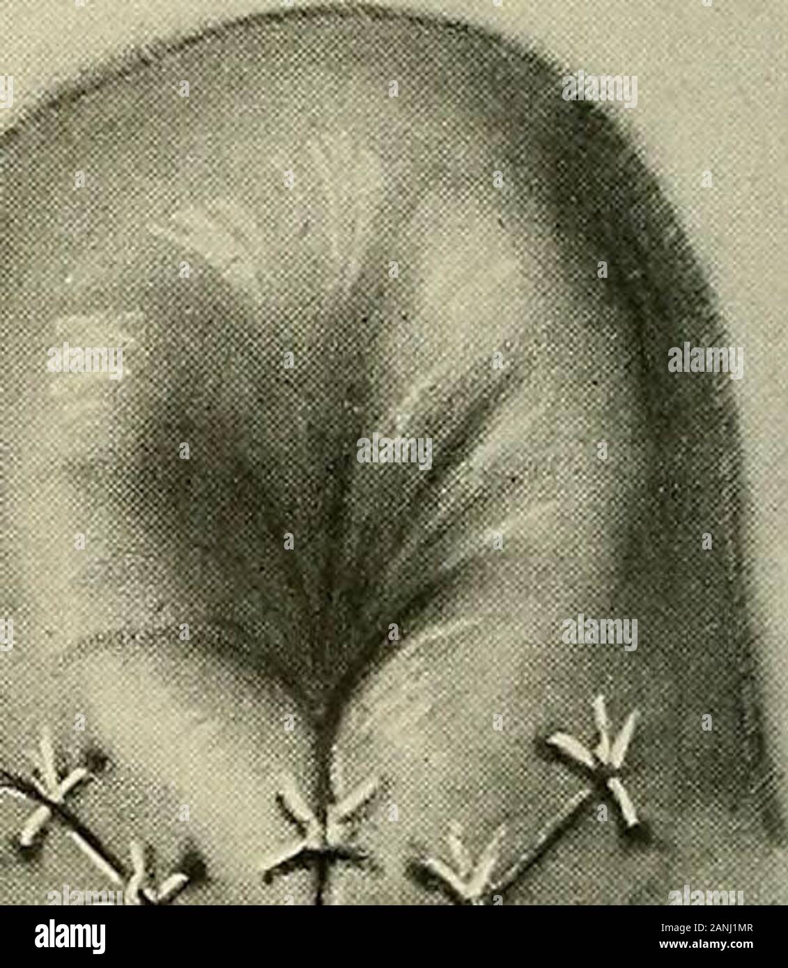 Gynecology . i^> W=>©^ Fig. 297.—Dudleys Operation for Ante-flexion ...