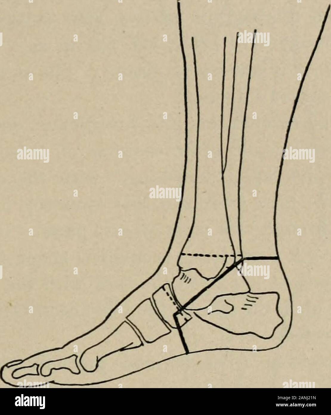 Operative surgery, for students and practitioners . oined to the leg at ...