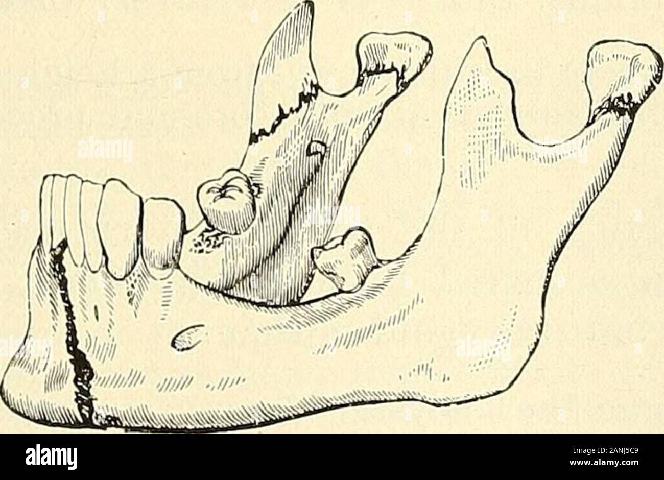 Compound bone fracture hi-res stock photography and images - Alamy