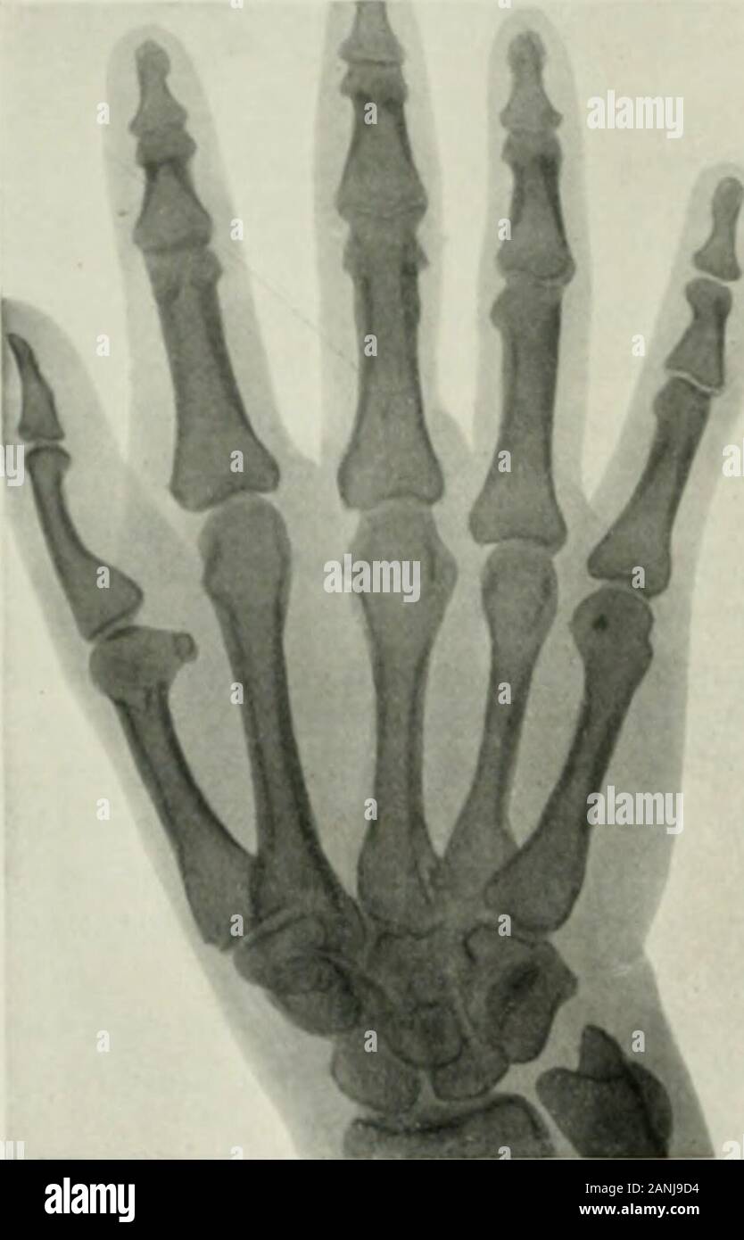 Congenital deformity of the hands hi-res stock photography and images ...