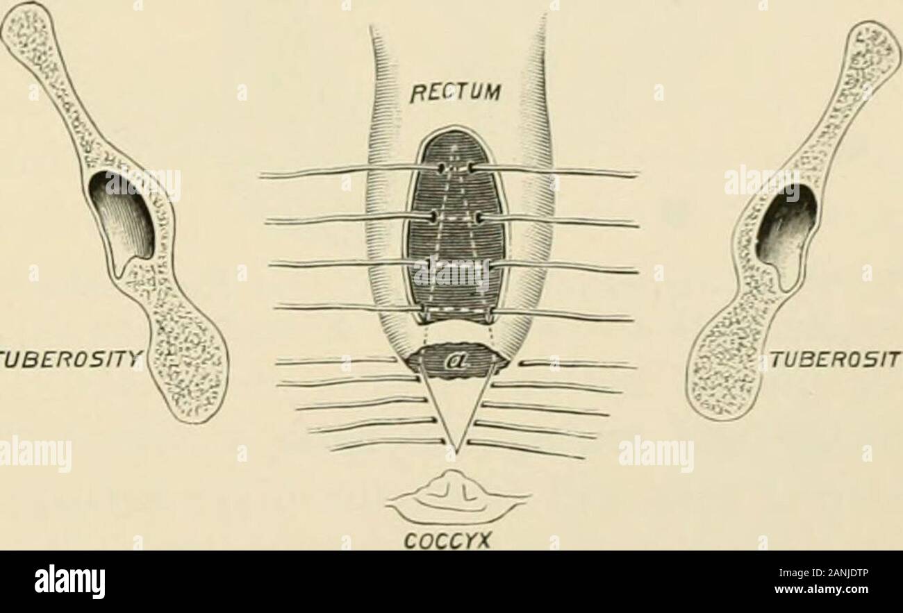Rectal bleeding hi-res stock photography and images - Alamy